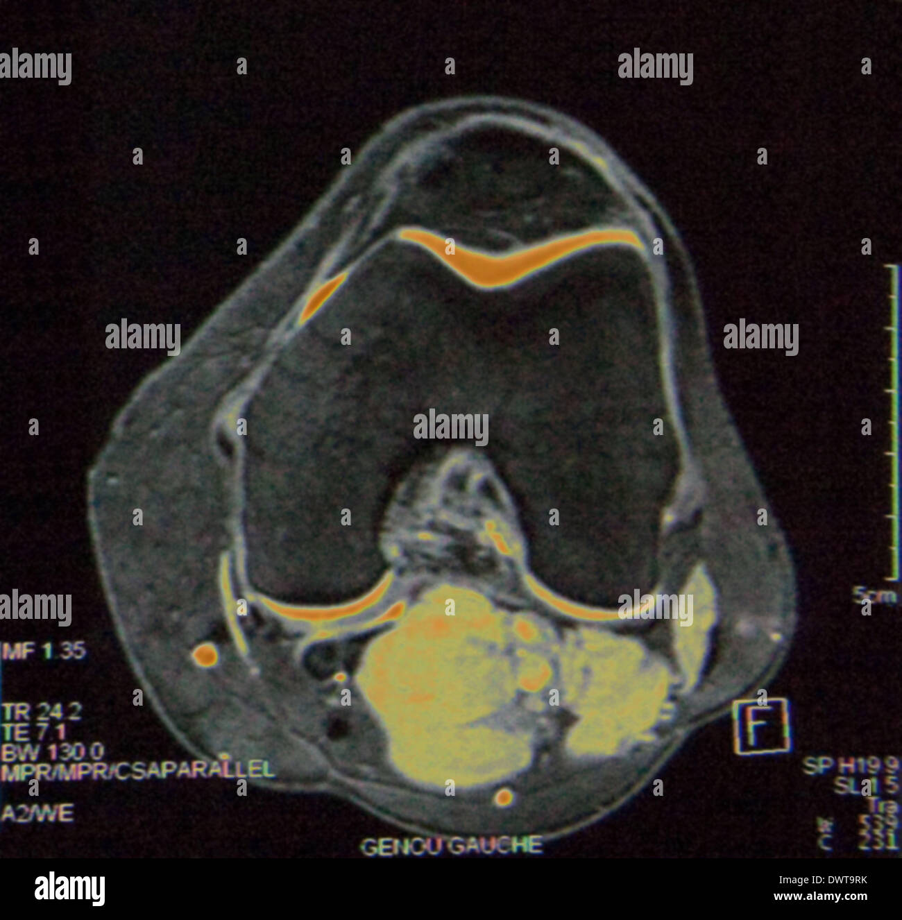 Popliteal hi-res stock photography and images - Alamy