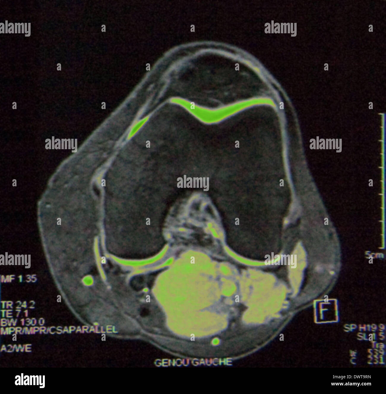 Musculus biceps femoris hi-res stock photography and images - Alamy