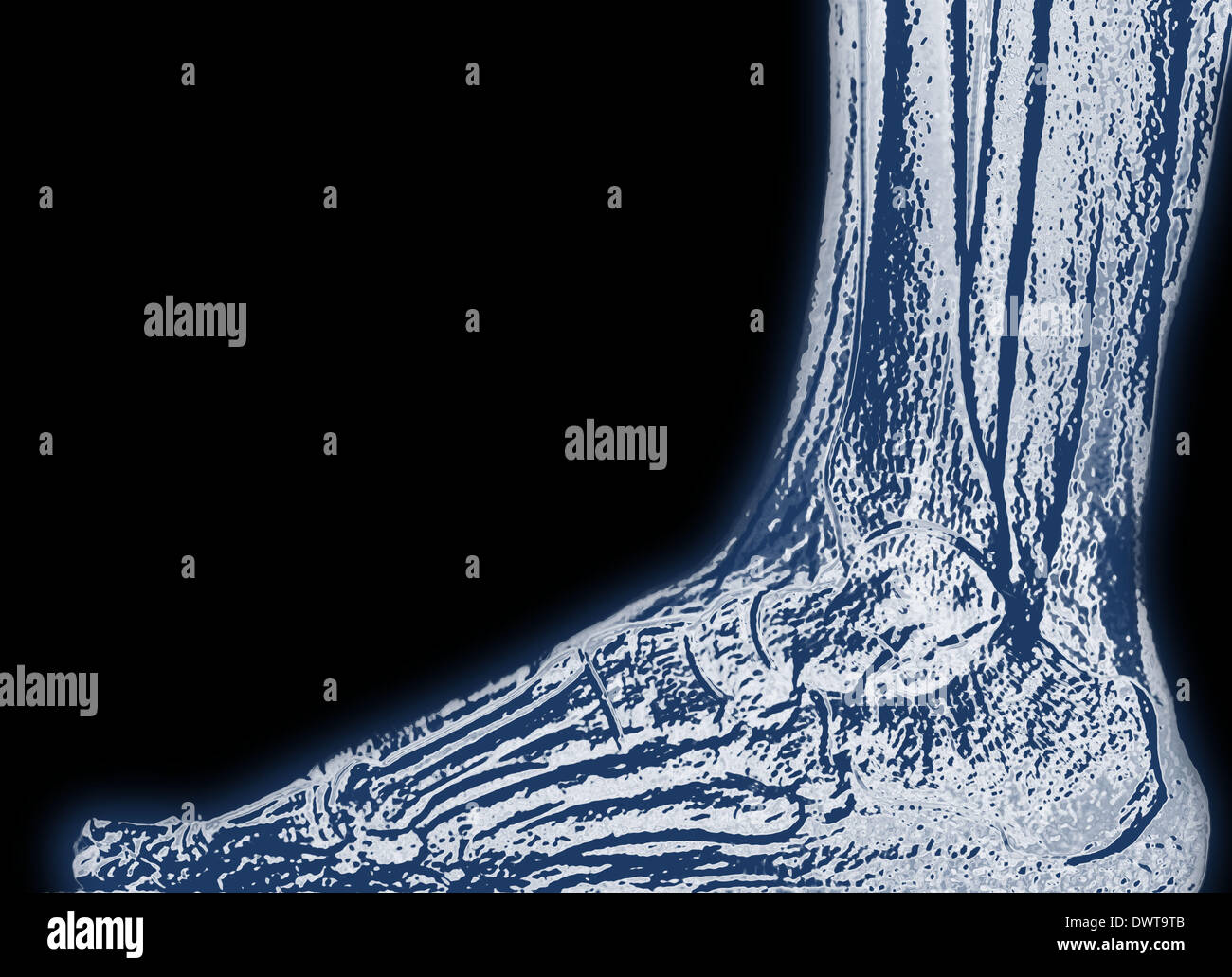 Foot scaphoid bone hi-res stock photography and images - Alamy