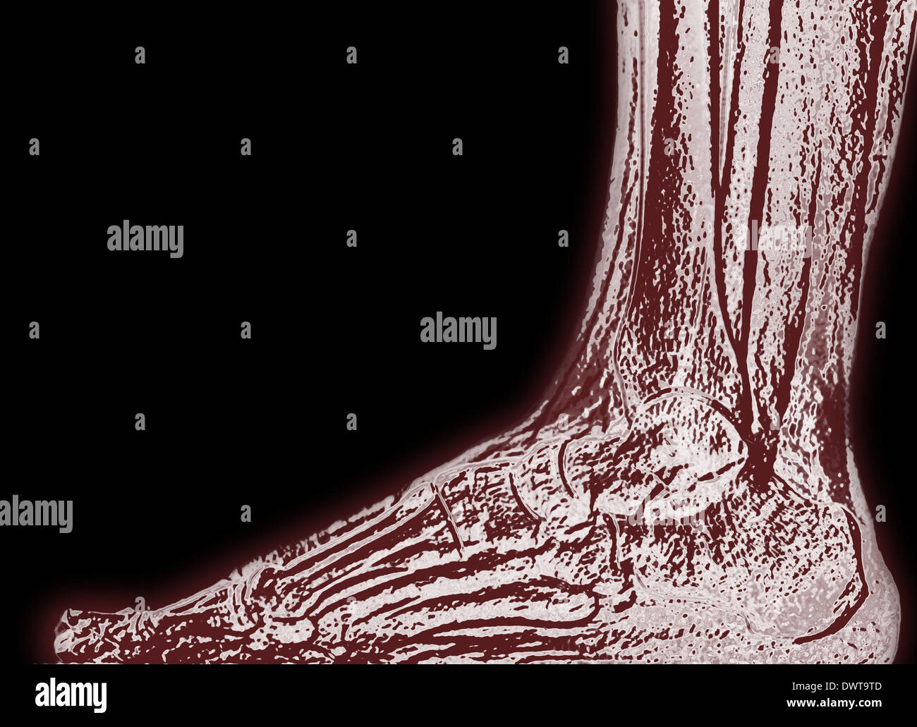 Foot scaphoid bone hi-res stock photography and images - Alamy