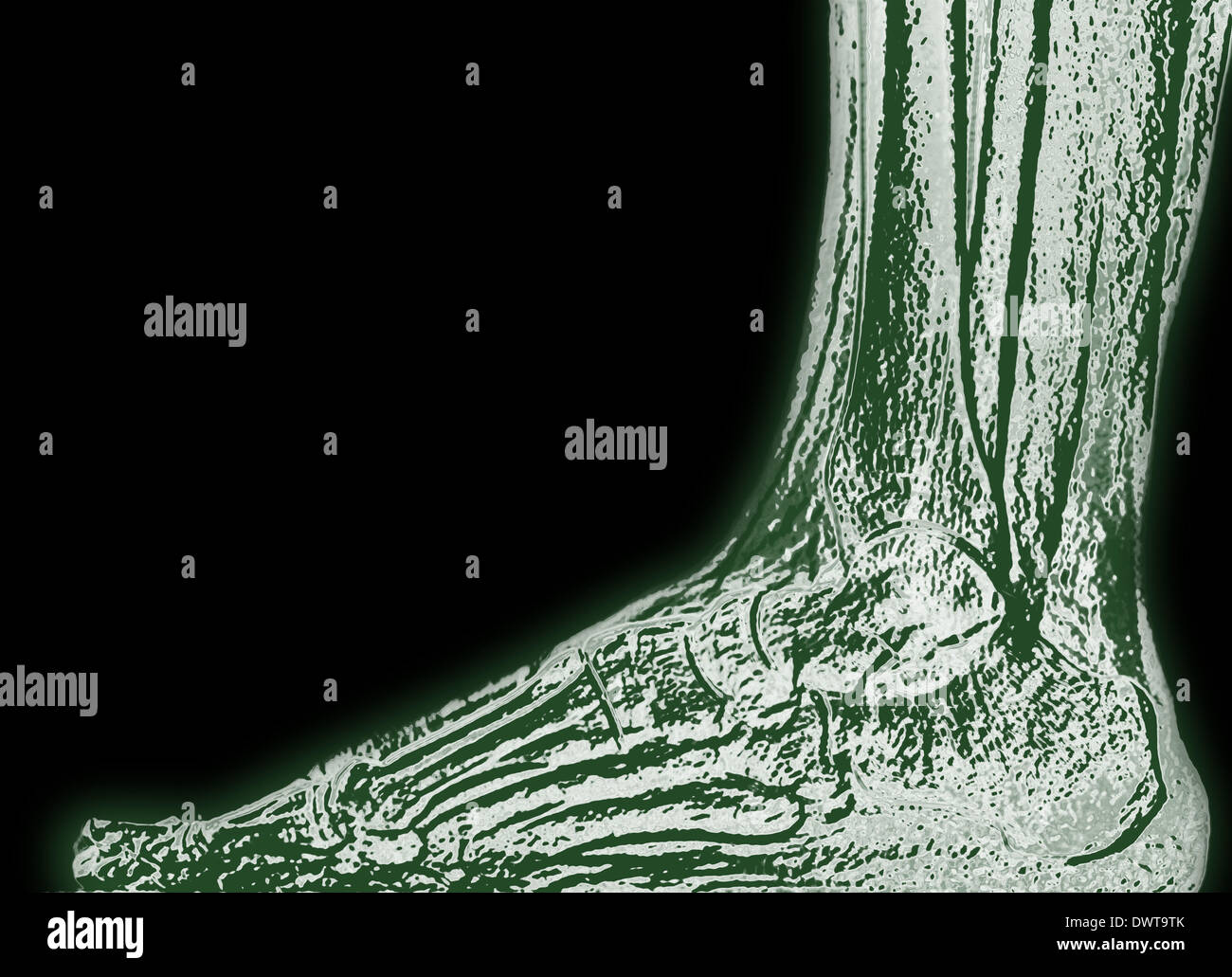 Foot scaphoid bone hi-res stock photography and images - Alamy