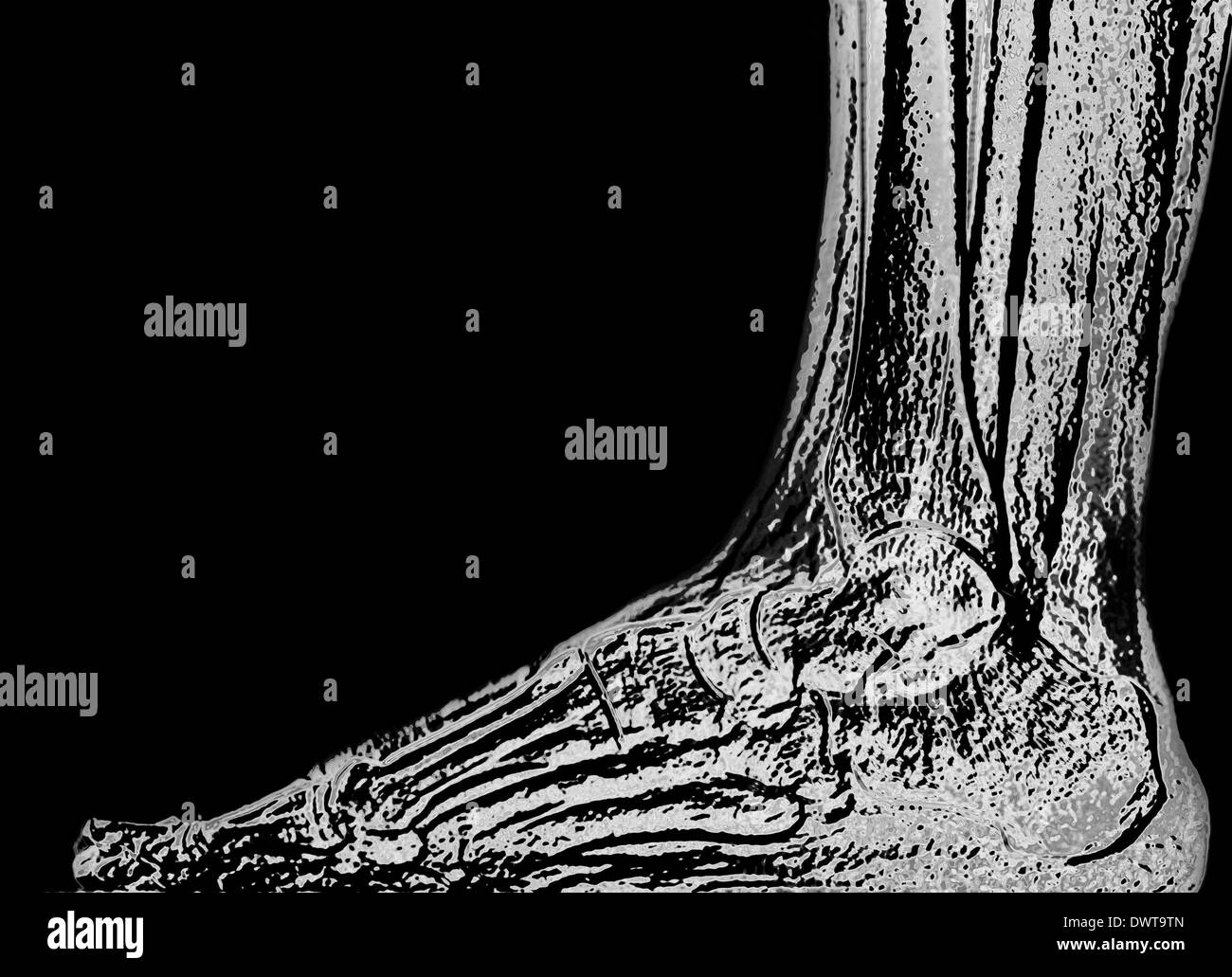 Medical foot Black and White Stock Photos & Images - Alamy