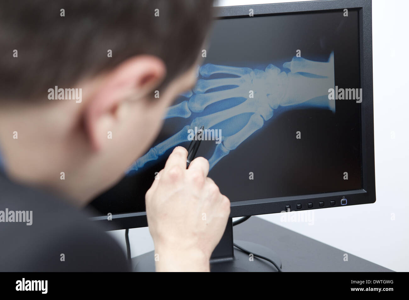 Hand radiography diagnosis Stock Photo - Alamy