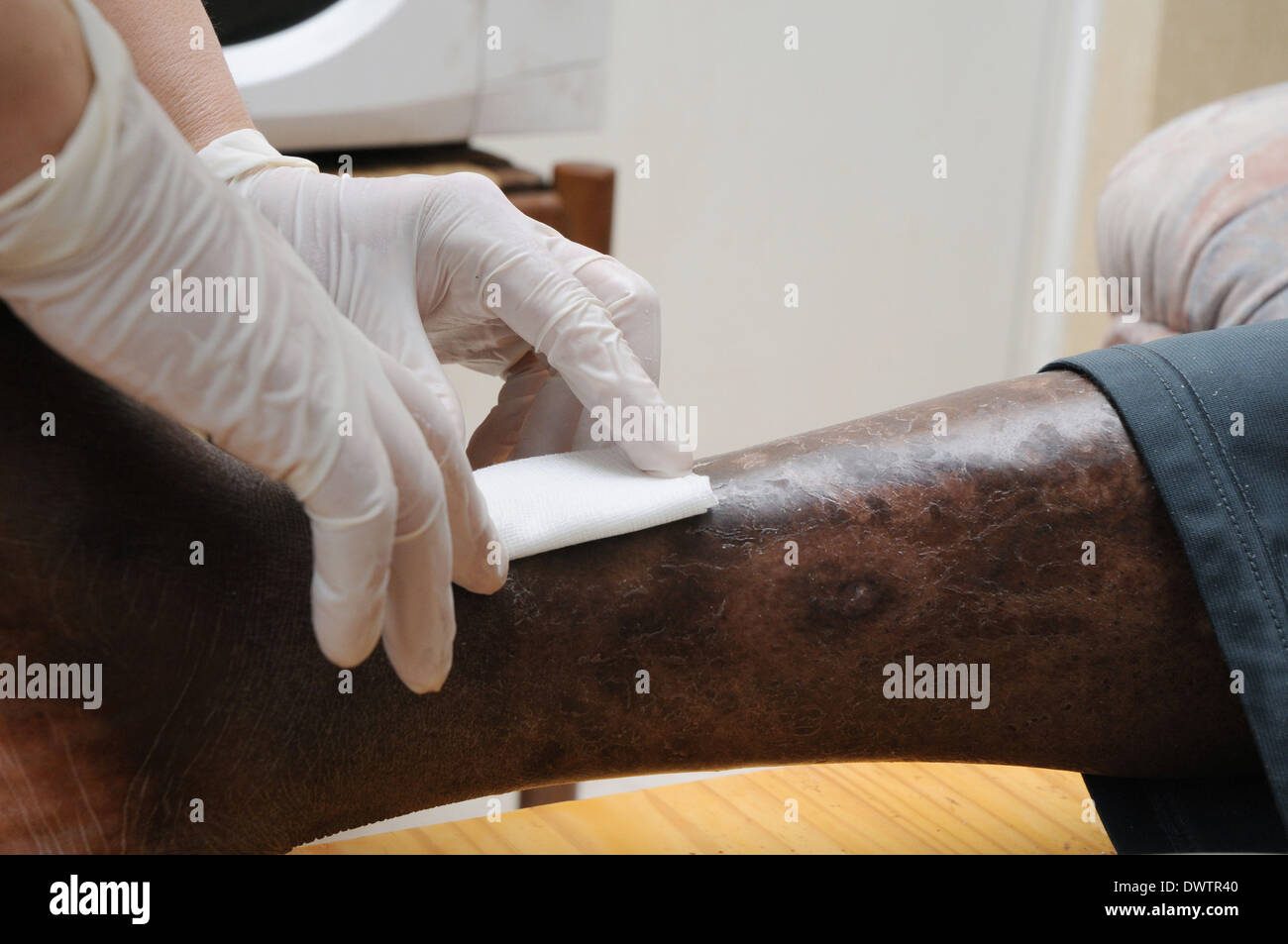 Neuropathic plantar ulcer hi-res stock photography and images - Alamy