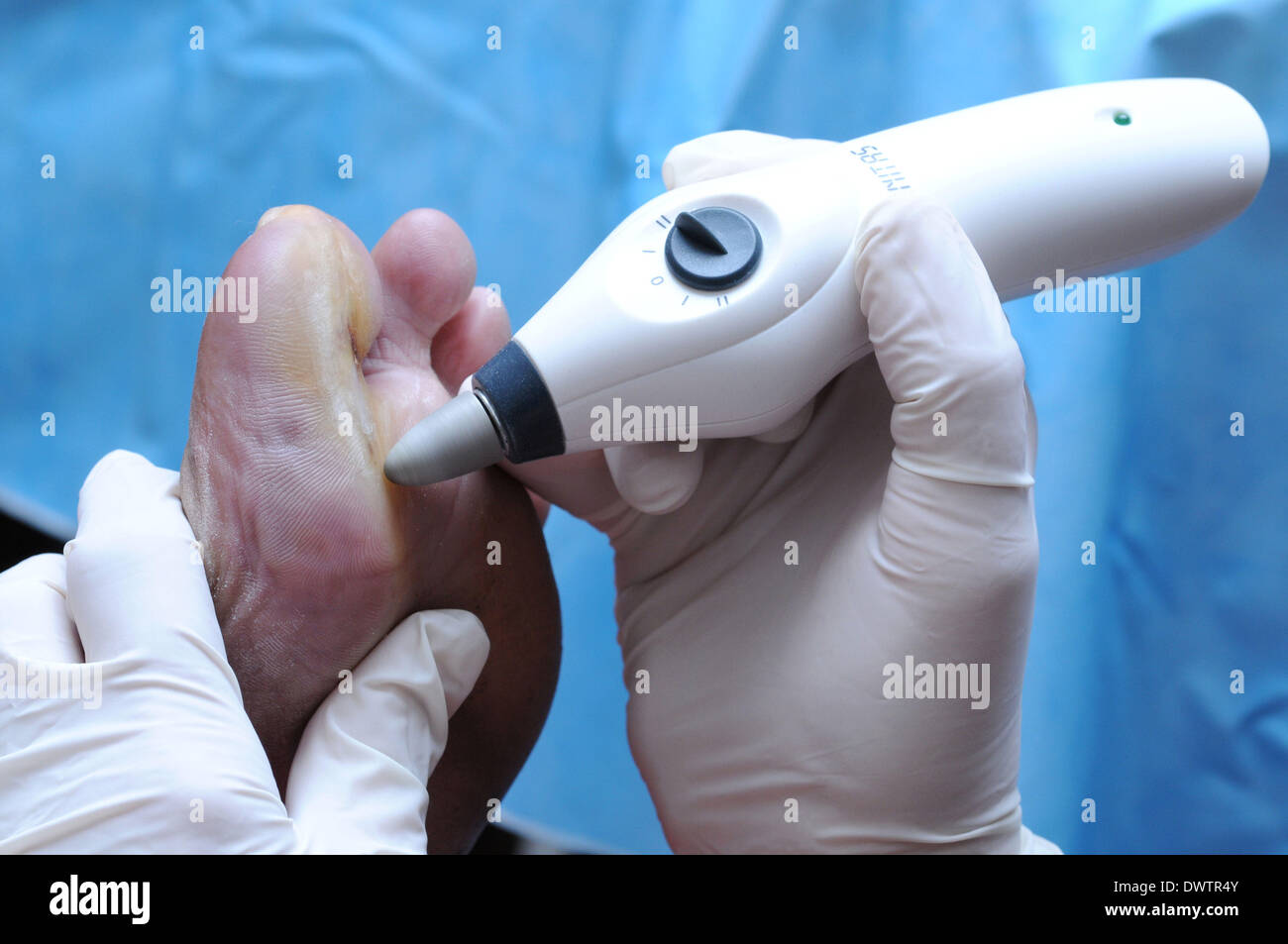 Neuropathic ulcer woman Stock Photo - Alamy