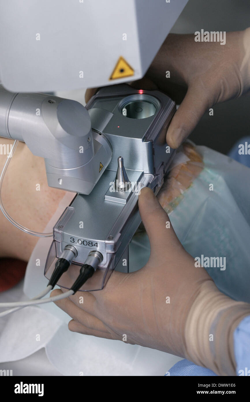 Surgery laser eye Stock Photo - Alamy