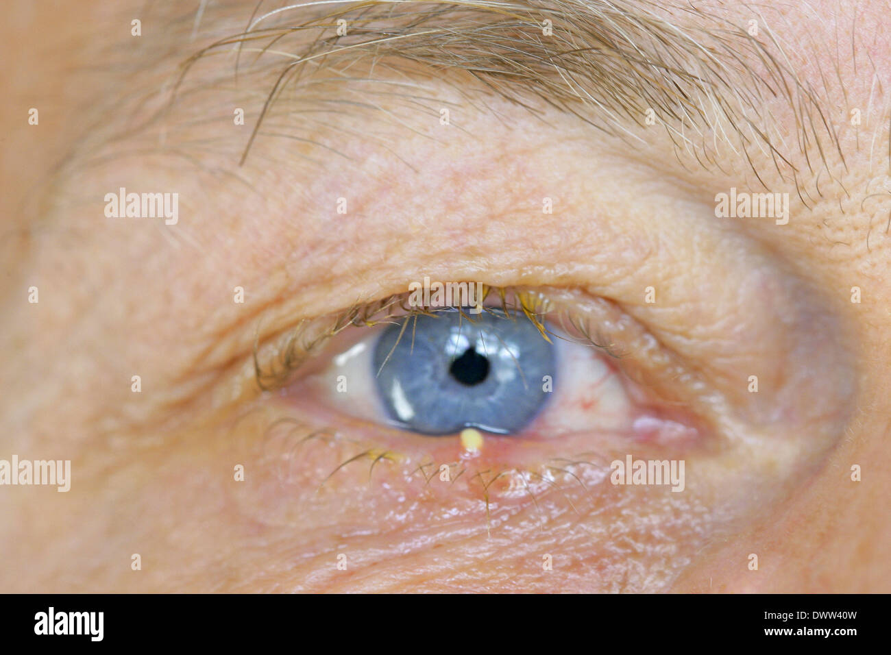 Stye eye hi-res stock photography and images - Alamy