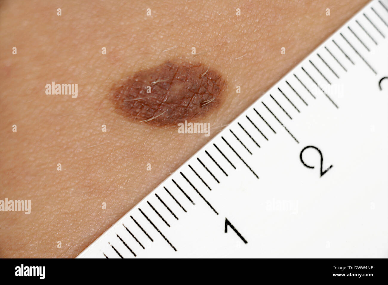 Beauty spot hi-res stock photography and images - Alamy