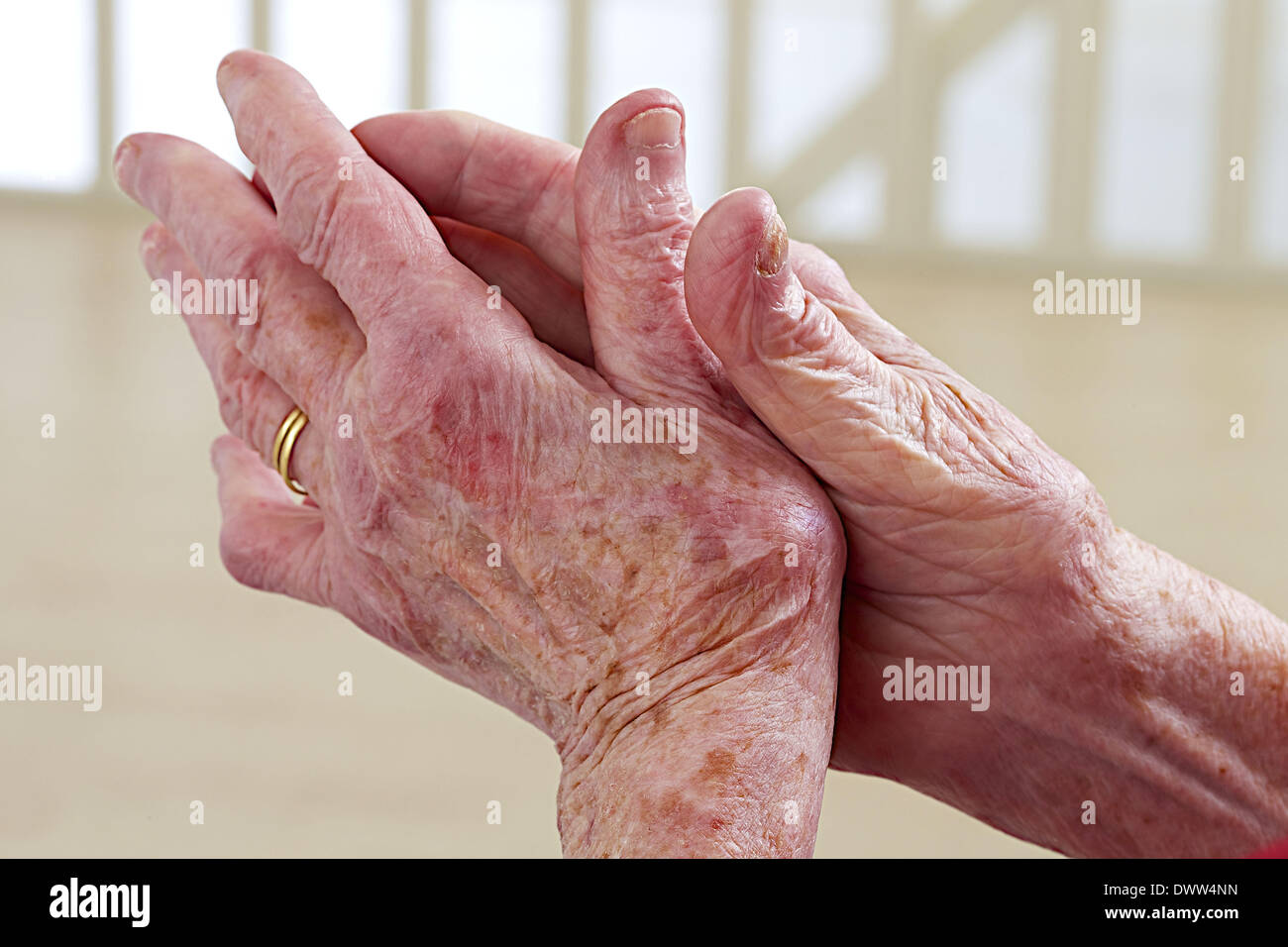 Mycosis nail hand senior Stock Photo - Alamy