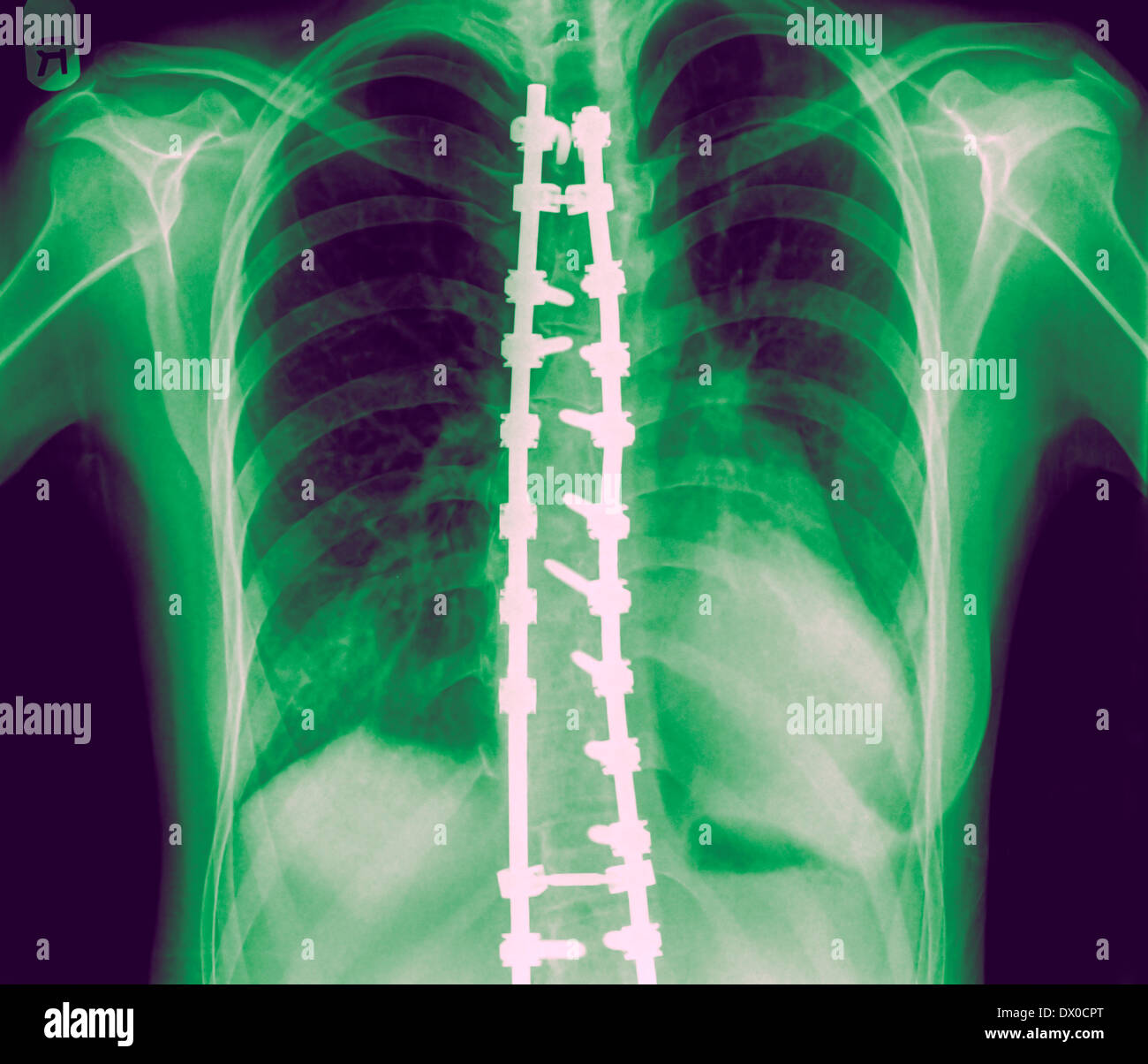 Spinal fusion, also known as spondylodesis or spondylosyndesis, x-ray ...