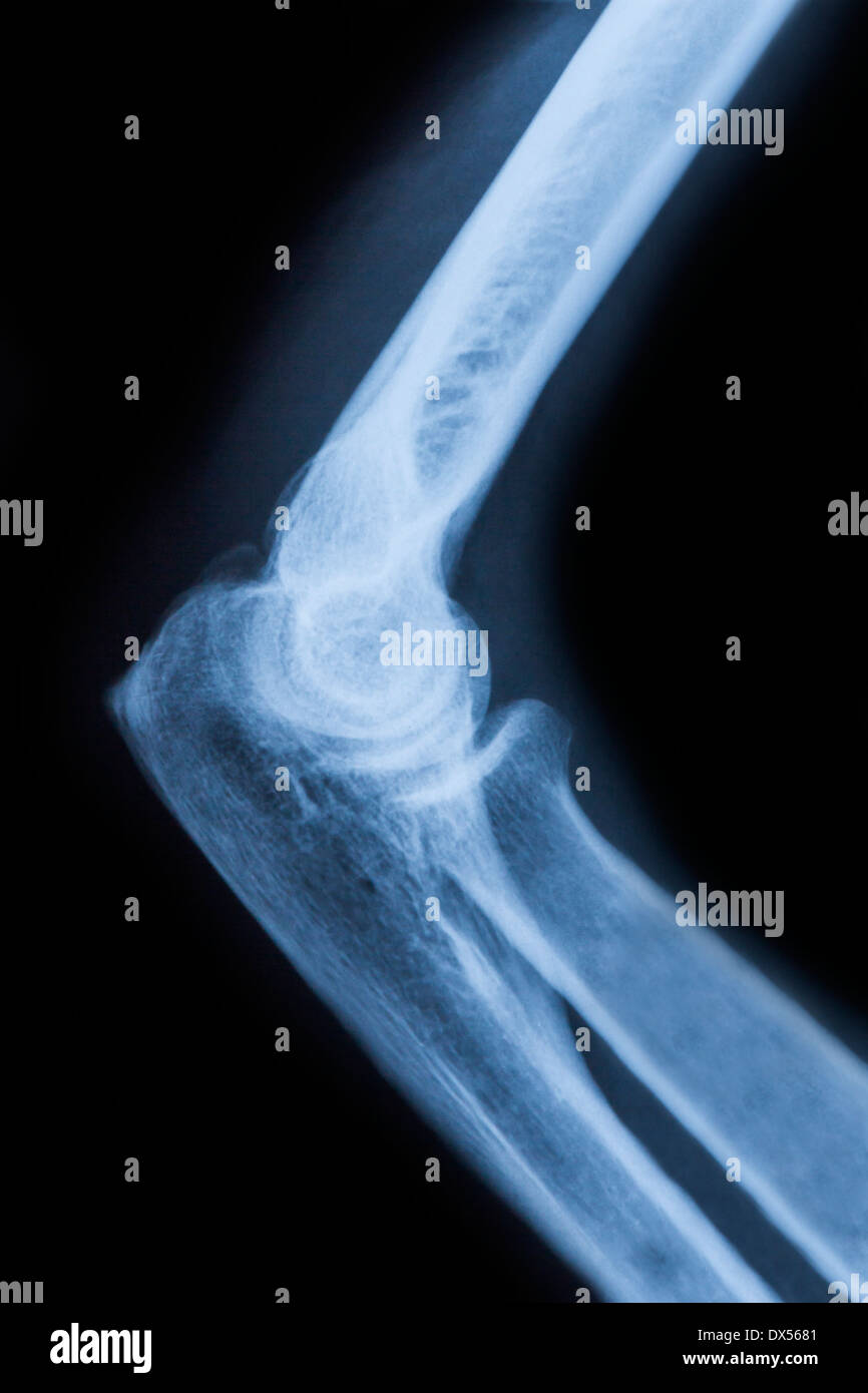 Chest Xray Ribs Lungs High Resolution Stock Photography and Images - Alamy