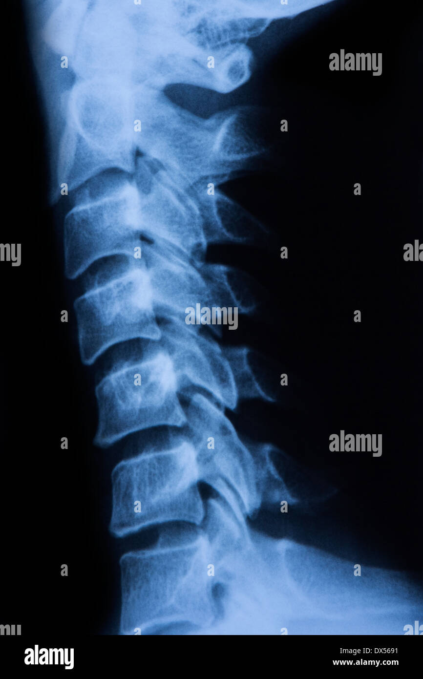 Chest Xray Ribs Lungs High Resolution Stock Photography and Images - Alamy