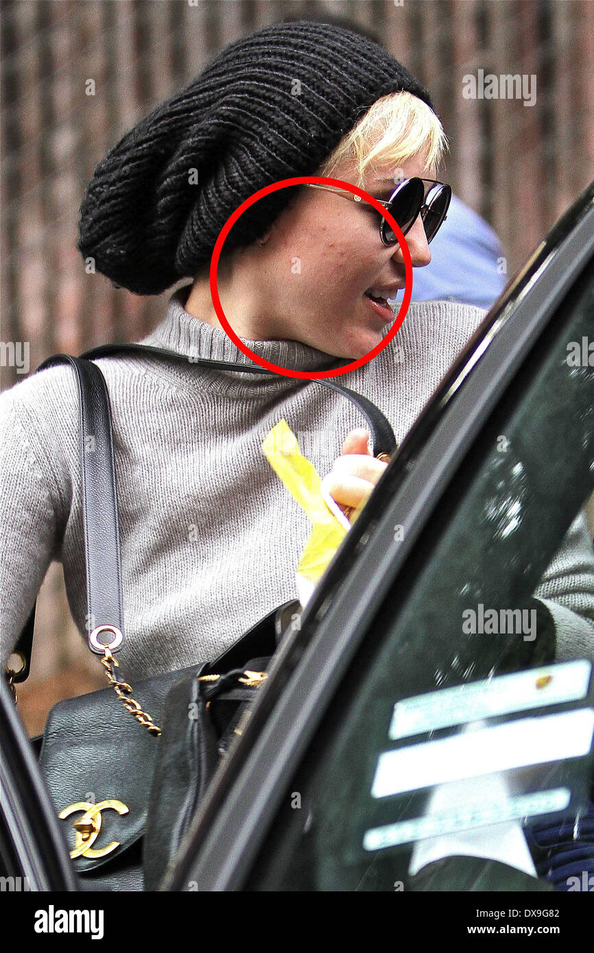 Miley Cyrus With Acne