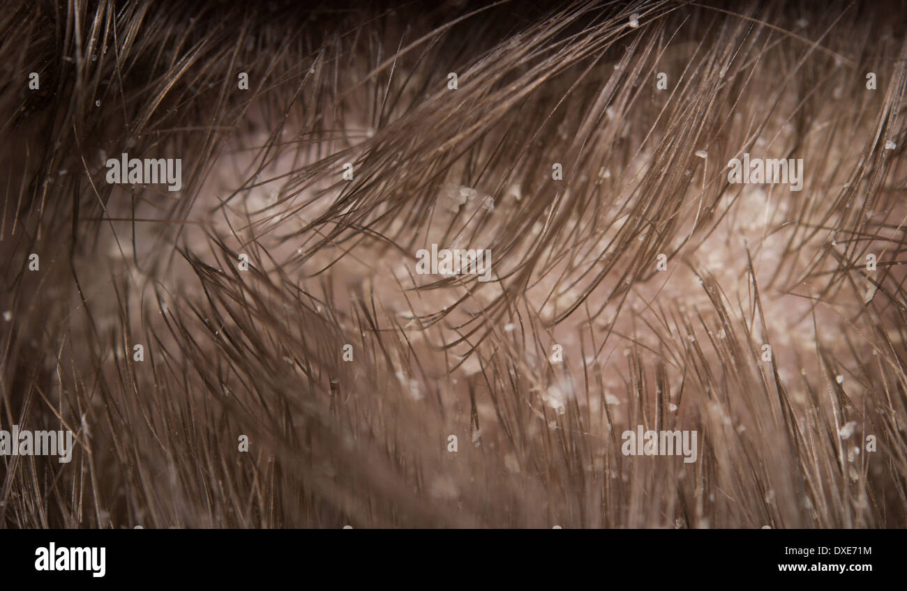 Dandruffclose hi-res stock photography and images - Alamy
