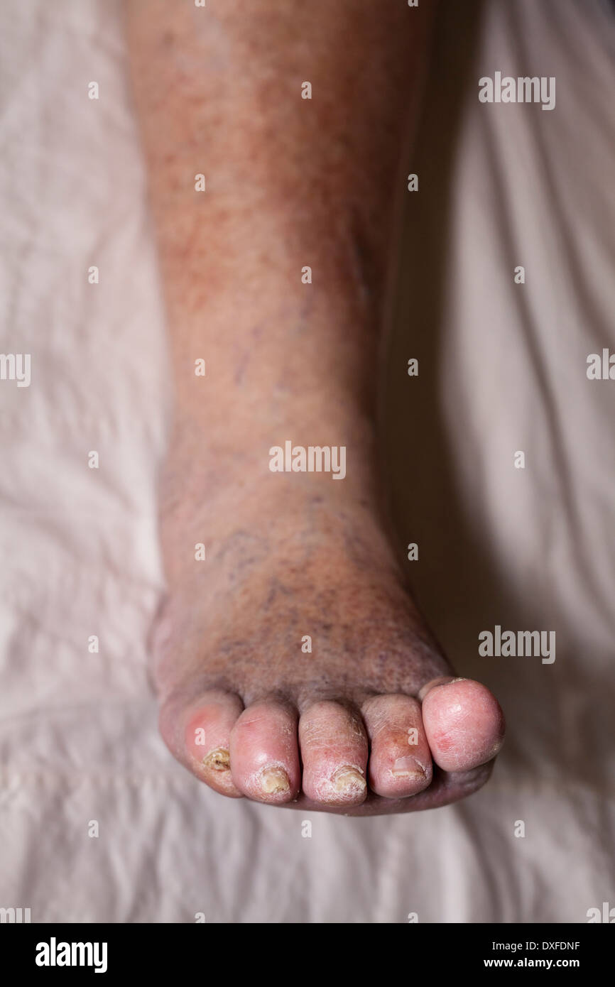 Detail of ill senior female swollen leg with damaged toes and nails ...