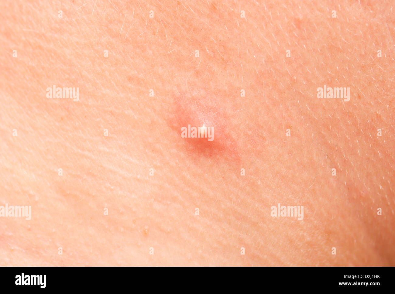 Papula hi-res stock photography and images - Alamy