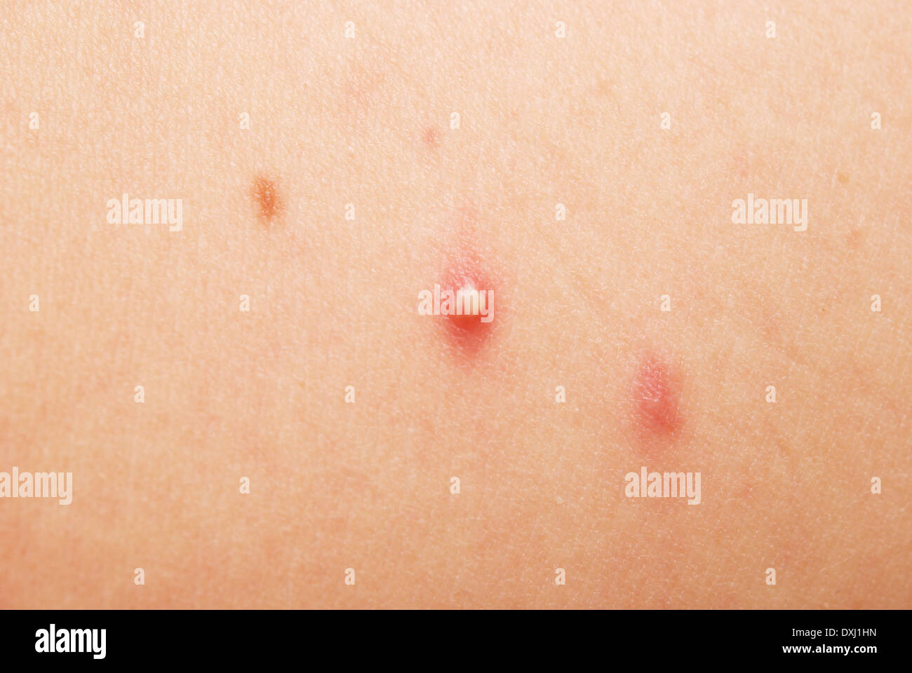 close up of pimple Stock Photo - Alamy