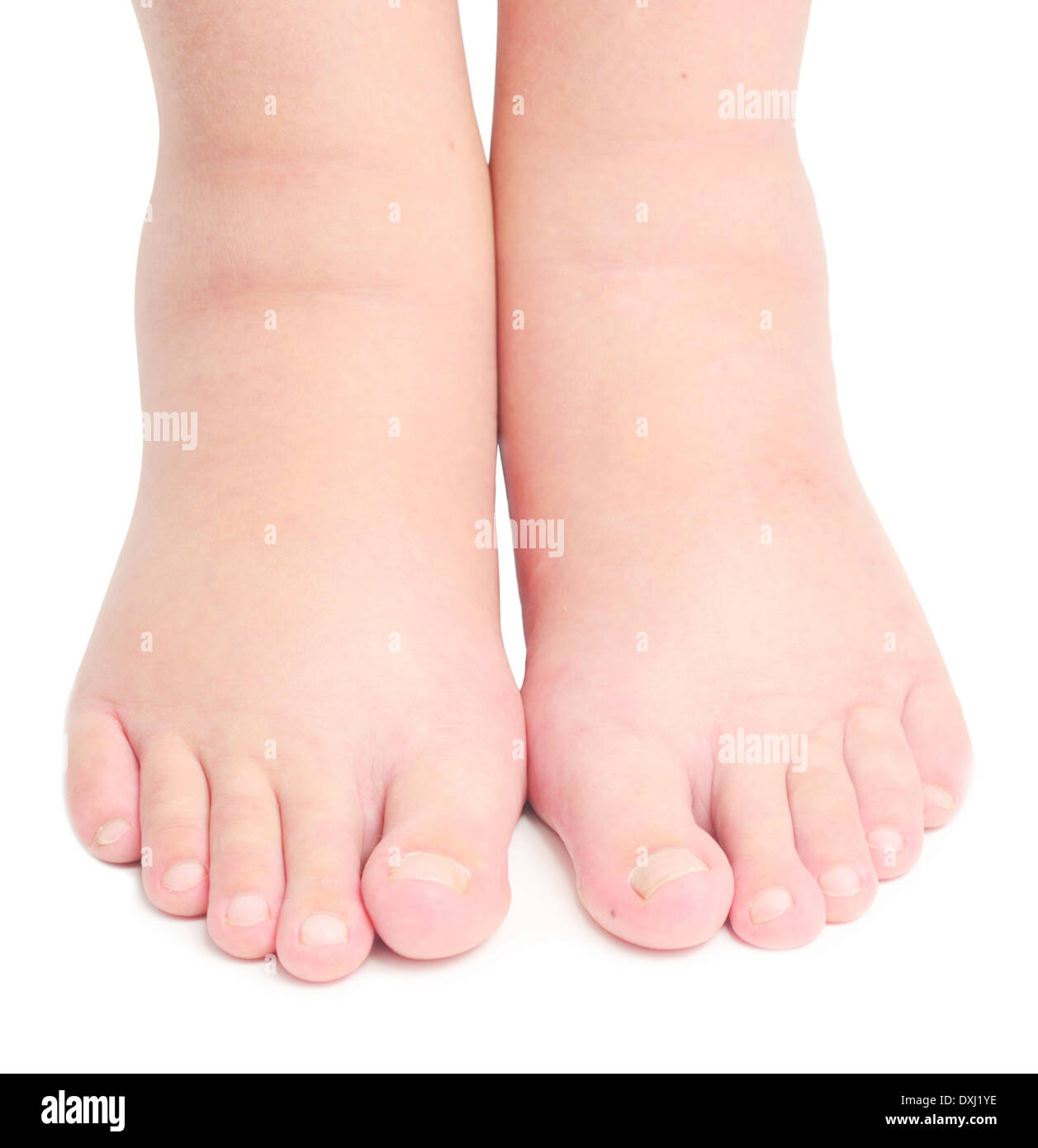 Edema feet hi-res stock photography and images - Alamy