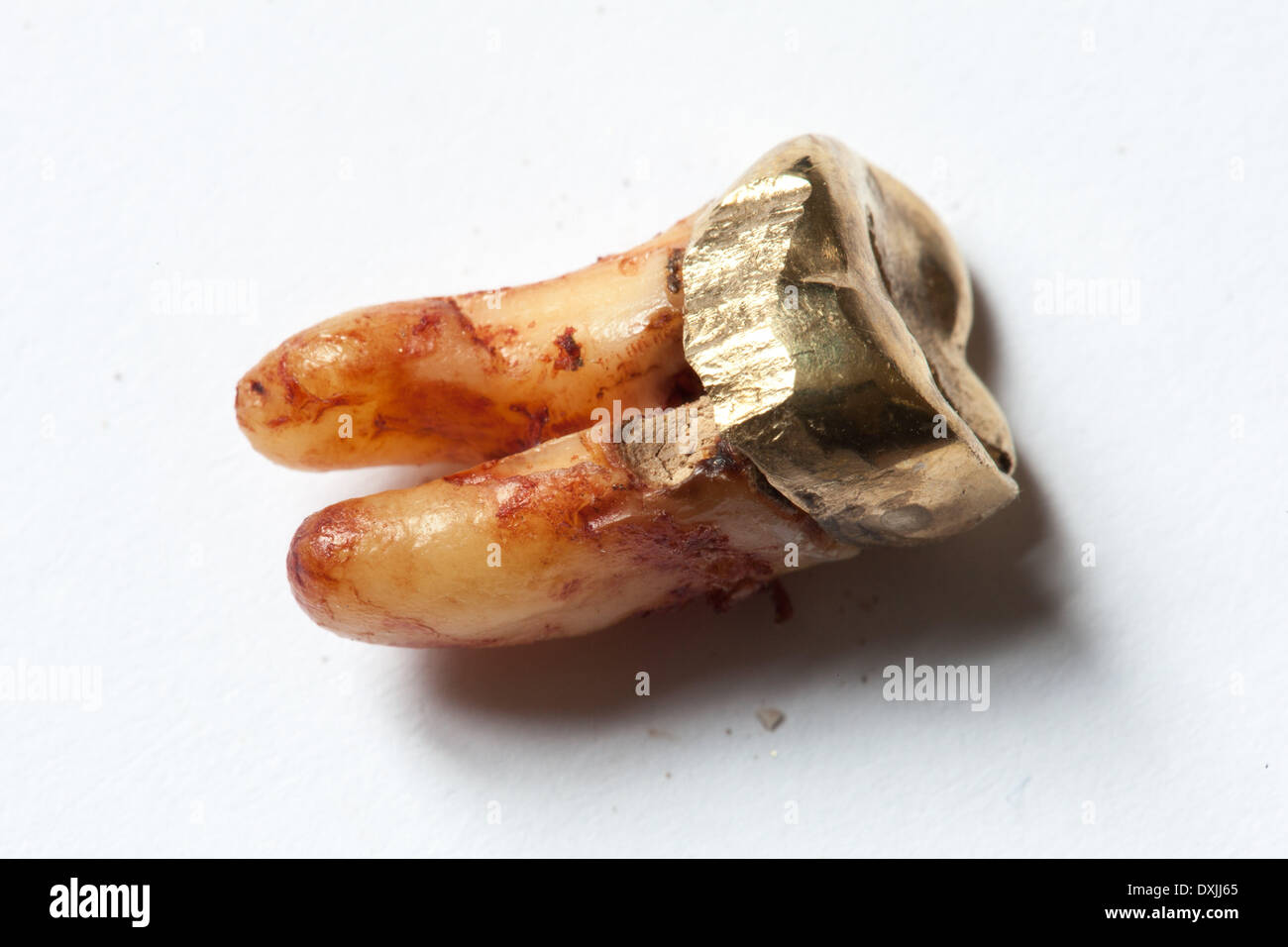 Gold tooth cap hi-res stock photography and images - Alamy