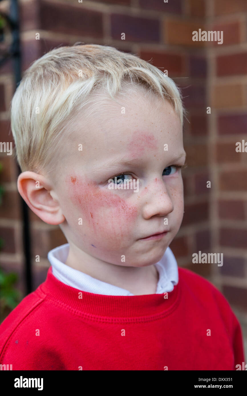 A young boy with a grazed ace Stock Photo - Alamy