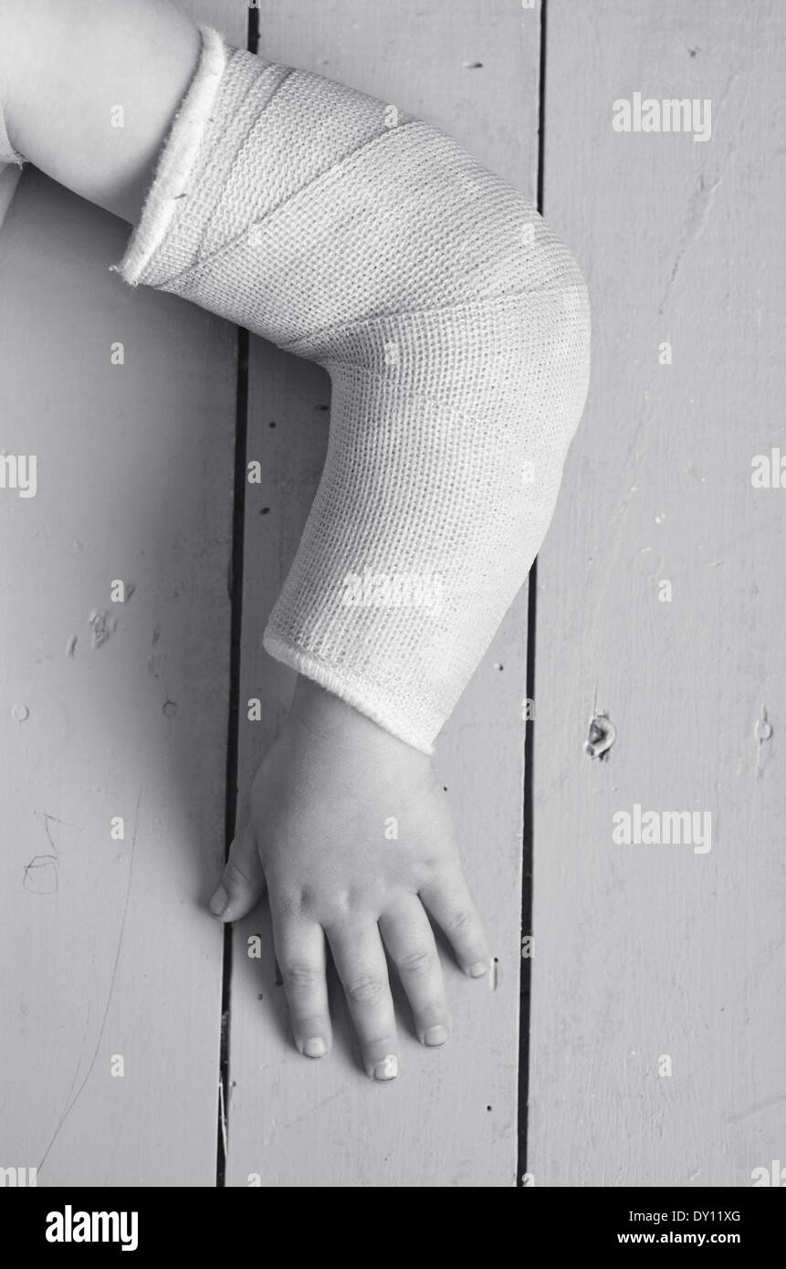Girl Arm Plaster Cast High Resolution Stock Photography and Images - Alamy