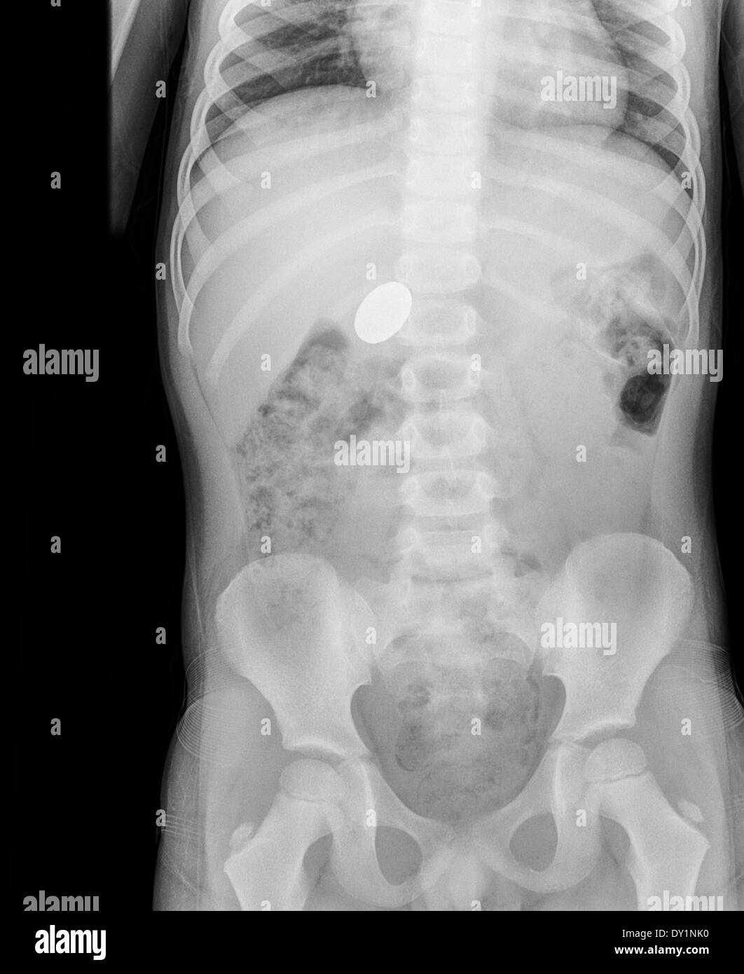 Child swallowed coin hi-res stock photography and images - Alamy
