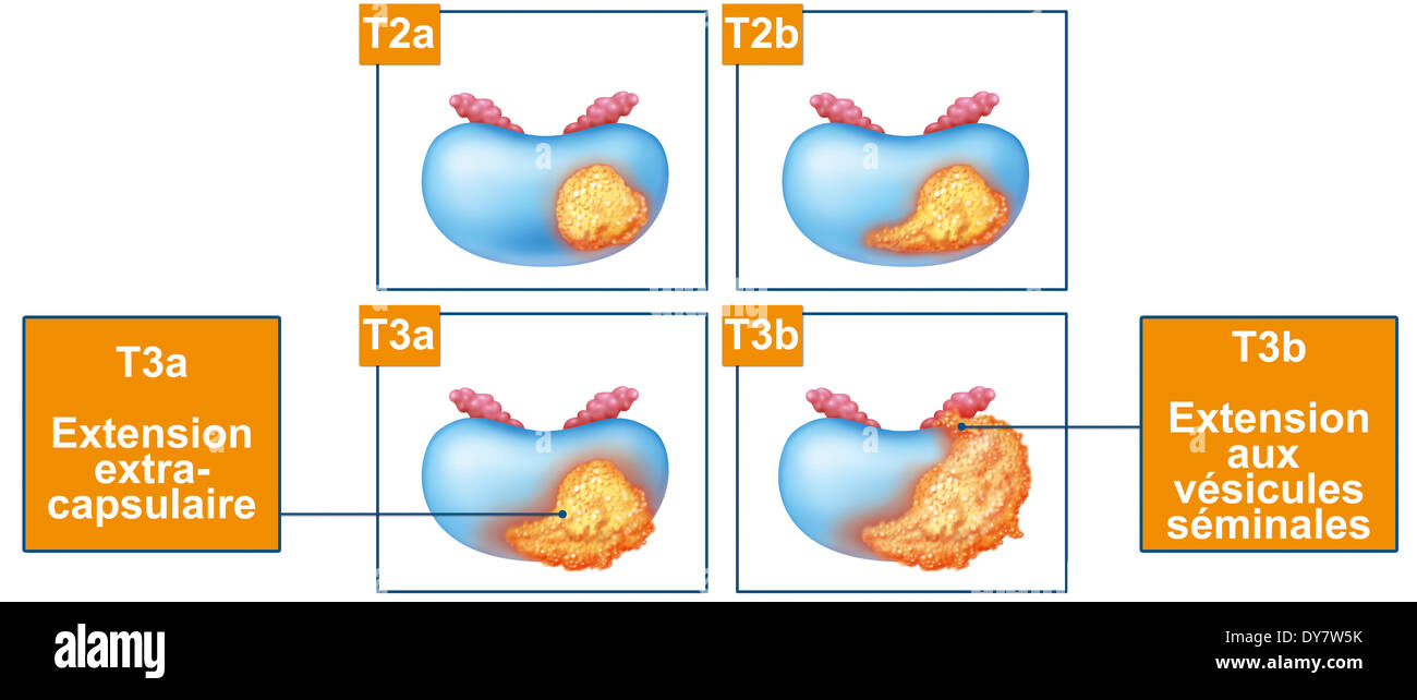 Cancer of the prostate, drawing Stock Photo - Alamy