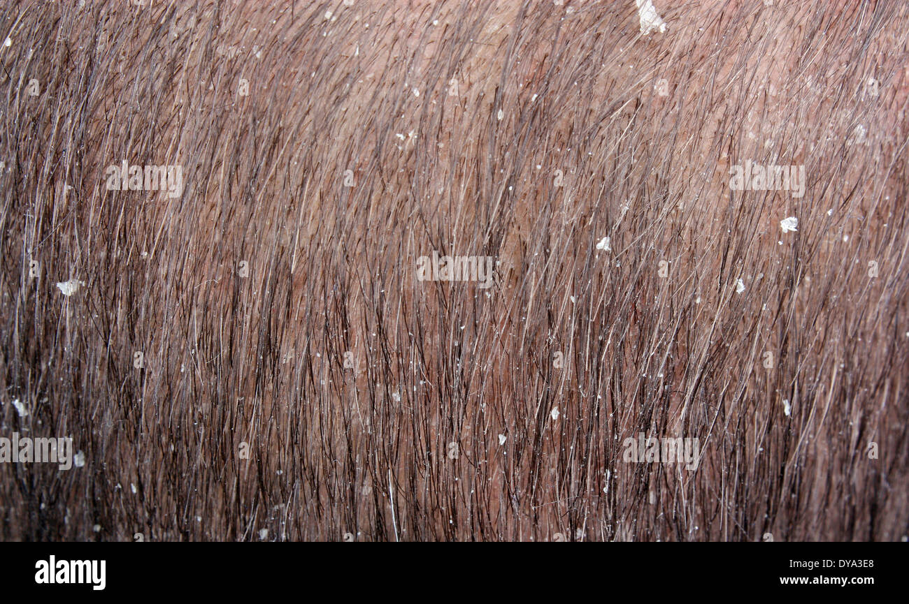Dandruff in the hair of a man Stock Photo - Alamy