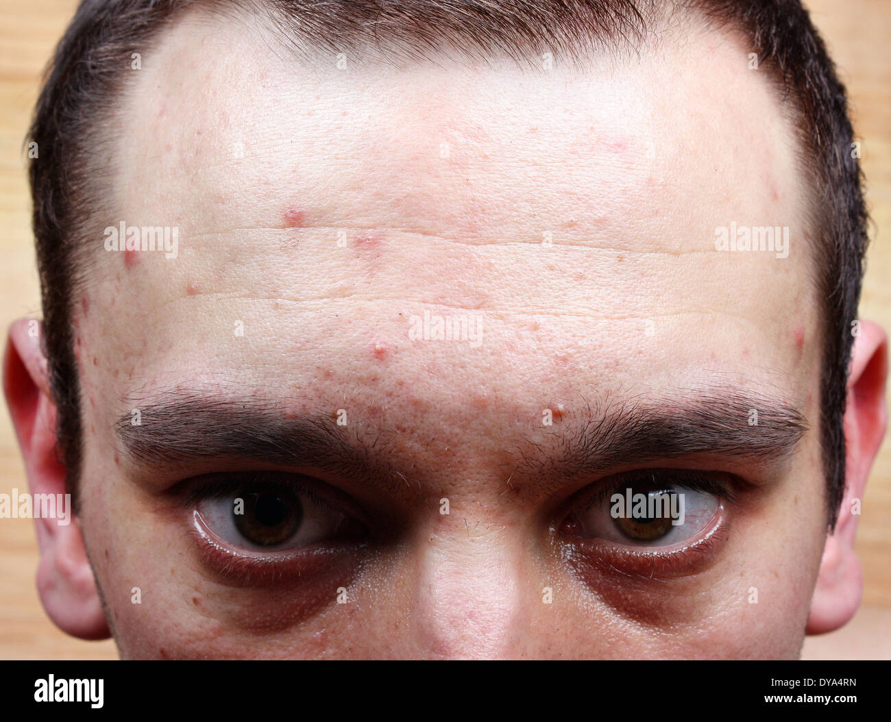 Dermatological disease acne pimples on the face of a man Stock Photo ...