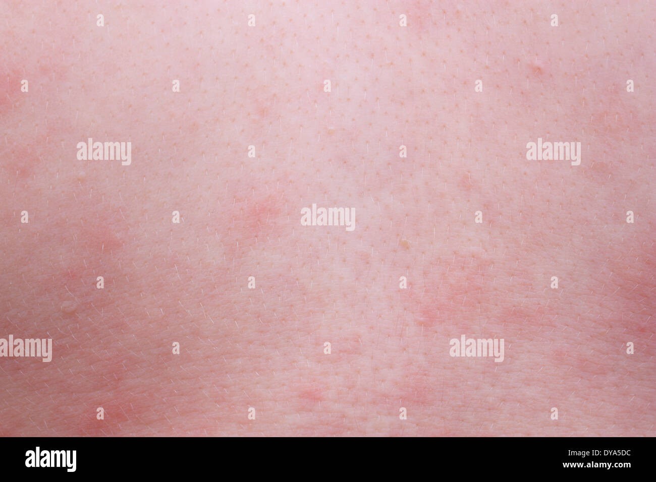 Skin rash sun allergy hi-res stock photography and images - Alamy
