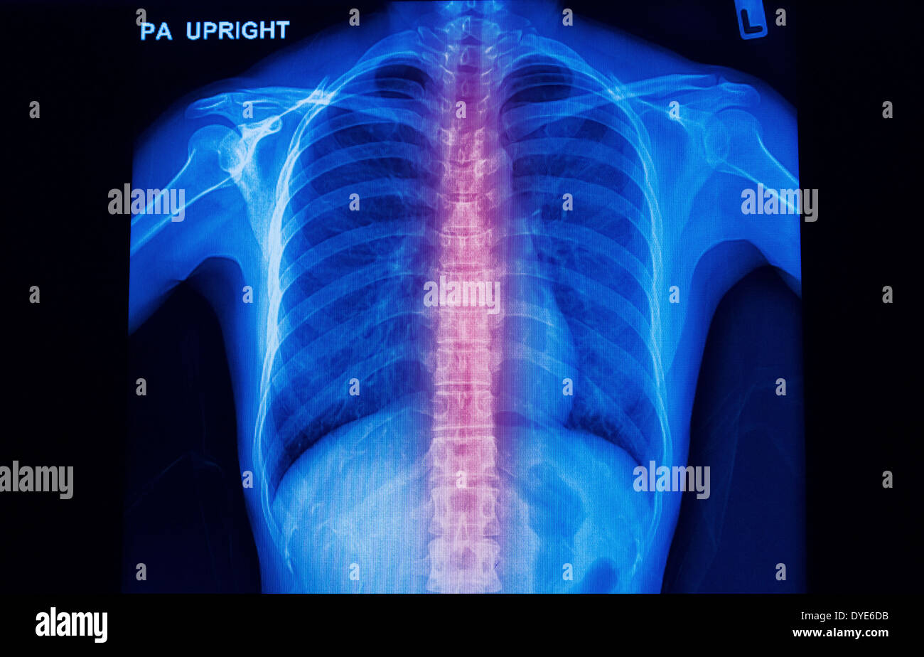 Human spinal column hi-res stock photography and images - Alamy