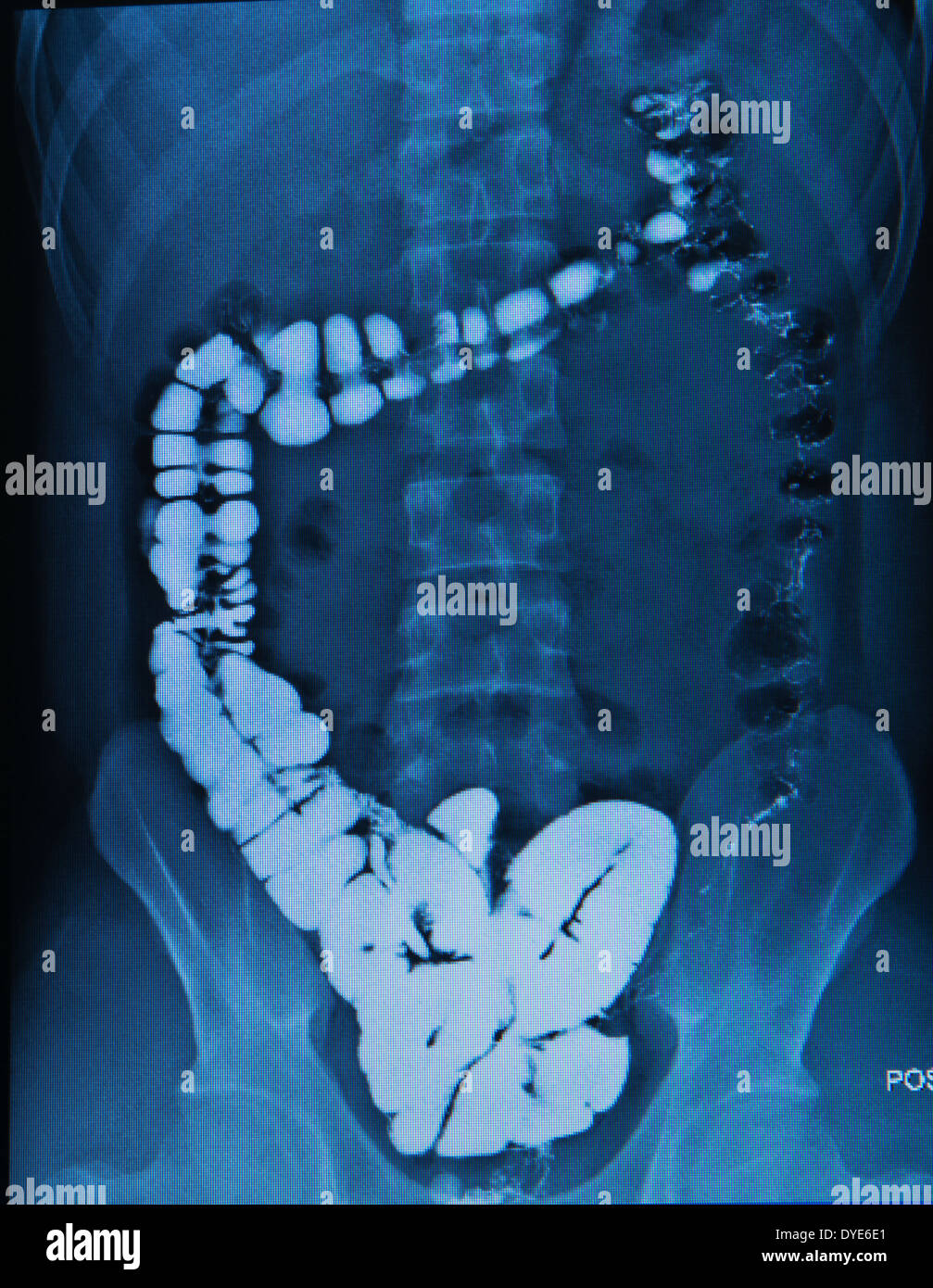 Barium enema hi-res stock photography and images - Alamy
