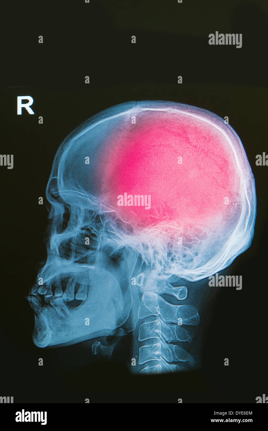 X Ray Head Injury Do You Have A Concussion? | Concussion.org