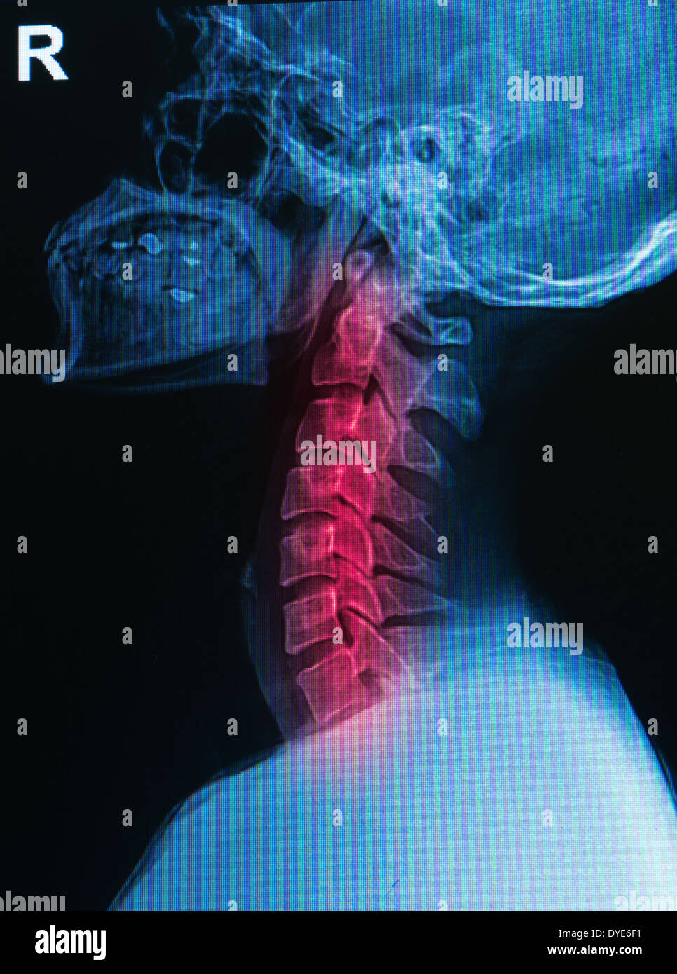 X-ray human skull and spine ( cervical spine ) show cervical injury ...