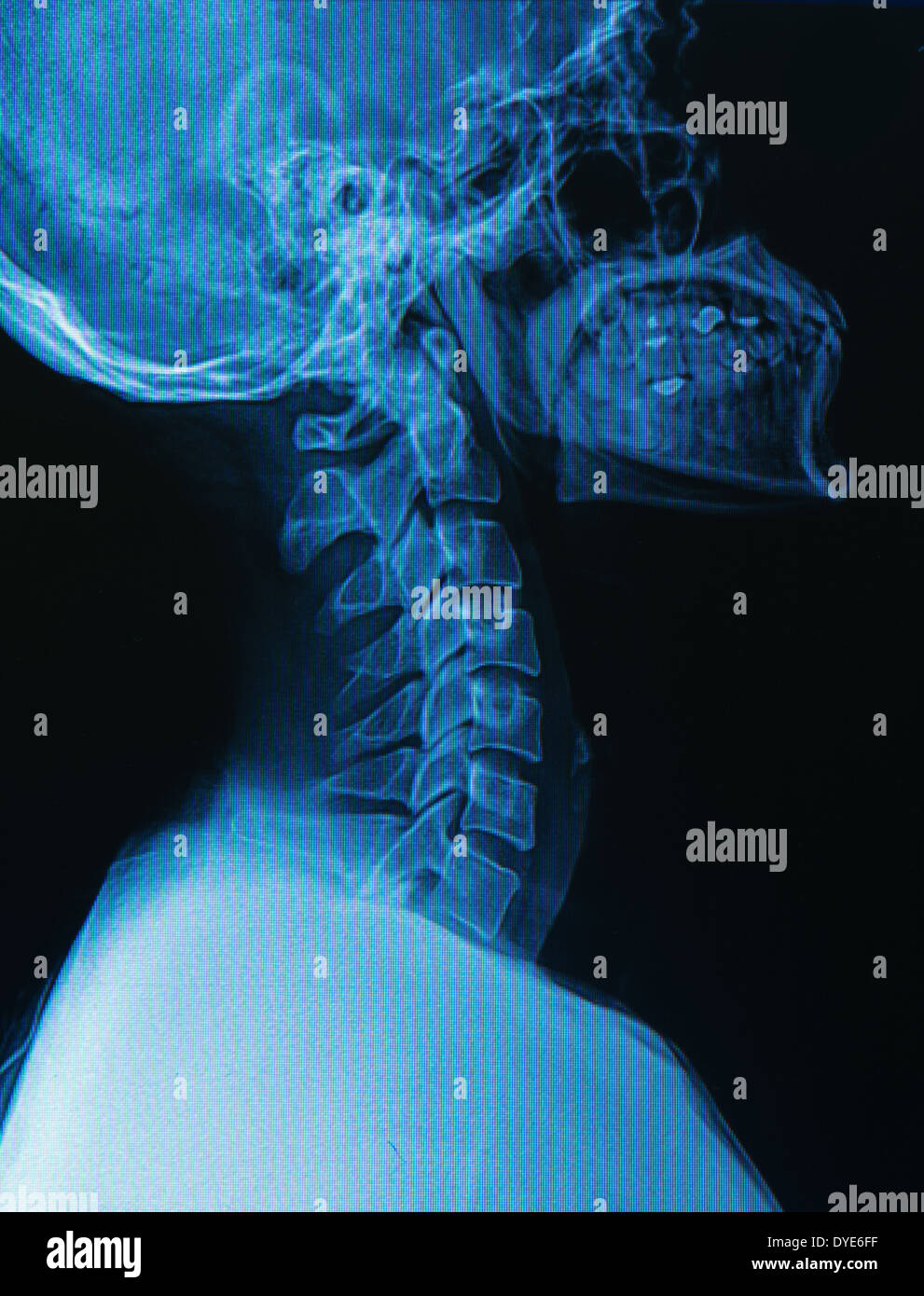 Spine injury neck pain hi-res stock photography and images - Alamy