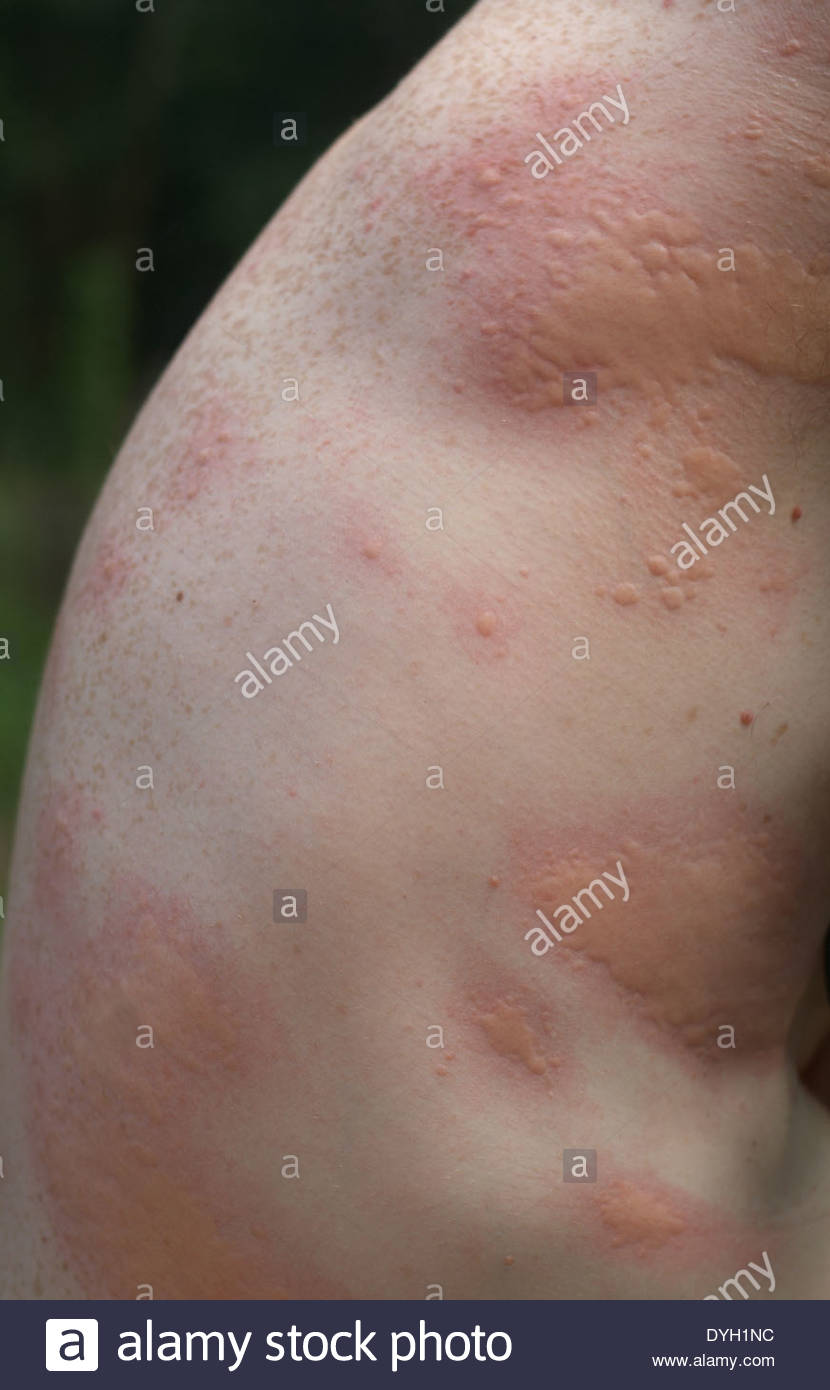 Rash Allergy Stock Photos & Rash Allergy Stock Images - Alamy