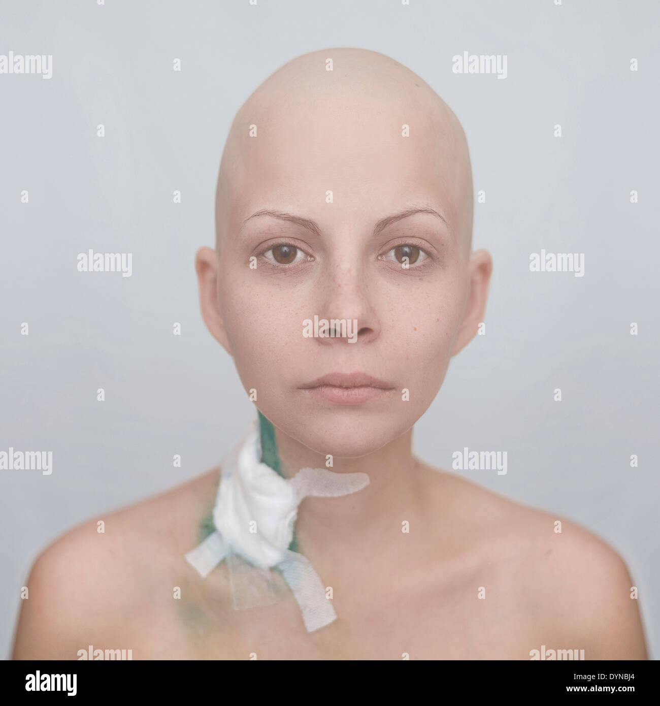 Bald Caucasian cancer patient with bandage on neck Stock Photo - Alamy