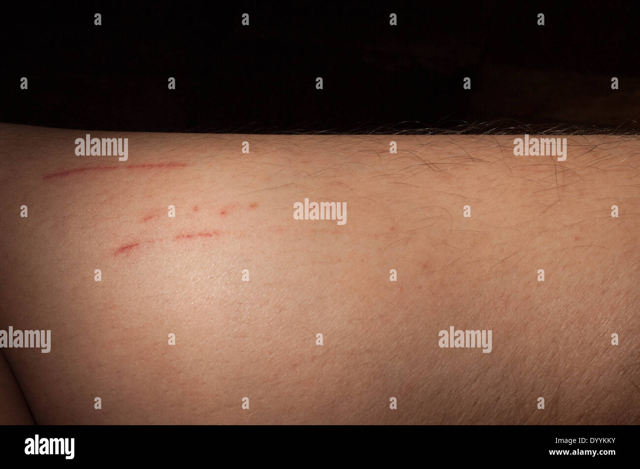 Blood scratch hi-res stock photography and images - Alamy