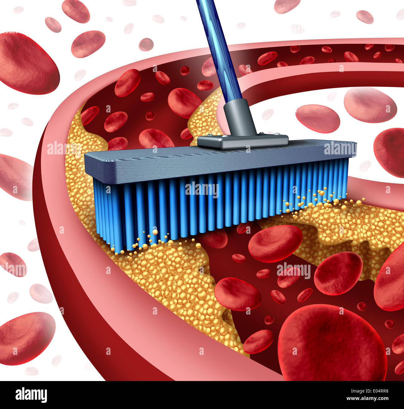 Cleaning arteries concept as a broom removing plaque buildup in a ...