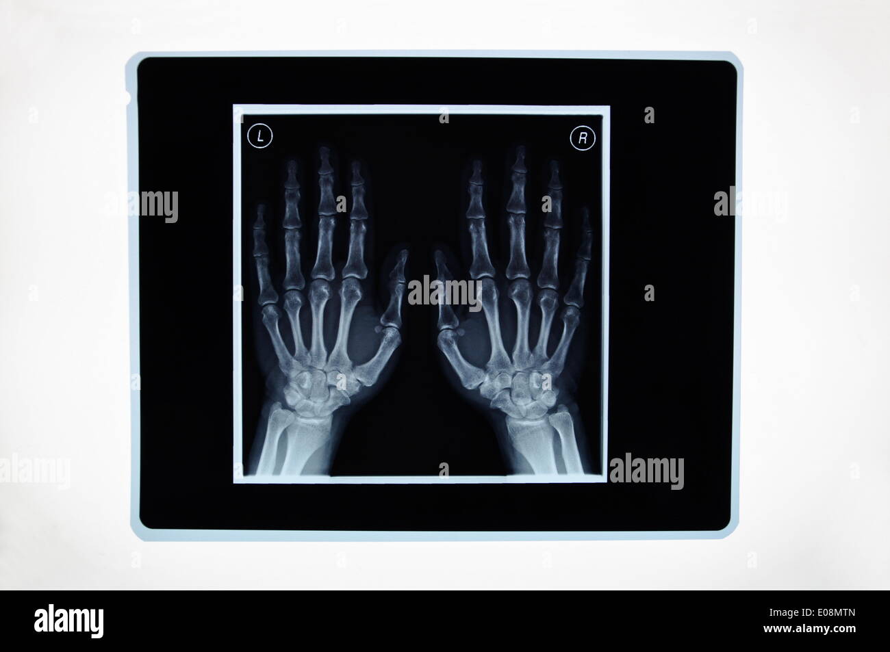 Rontgen hand hi-res stock photography and images - Alamy