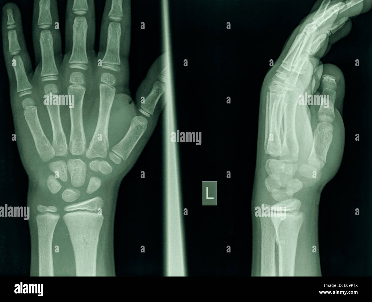 X Ray Of Human Hand With Broken Wrist Fracture Of Radius
