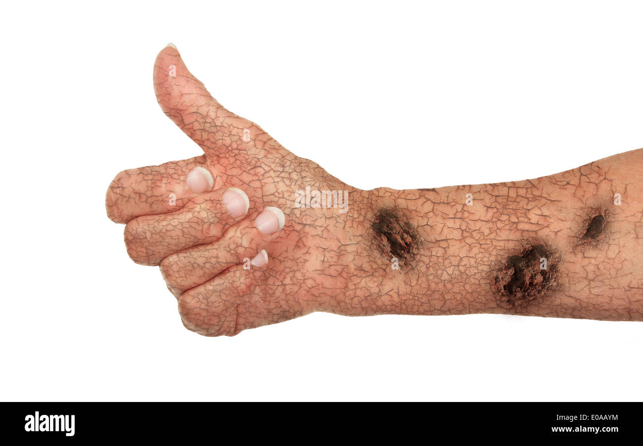 Old arm with cracks and rust concept of getting old giving the thumbs ...