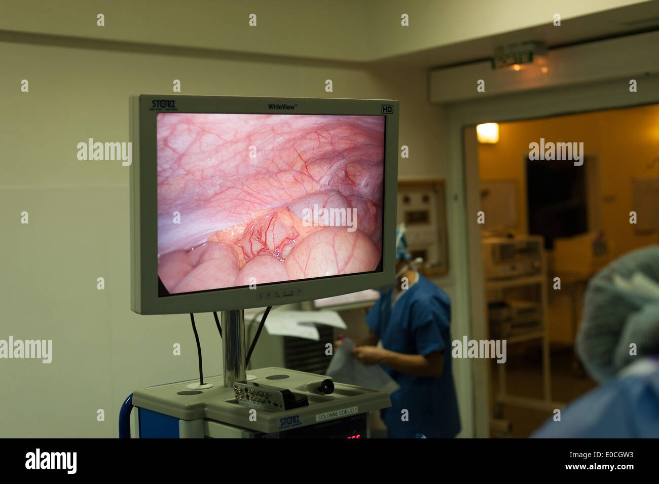 Laparoscopic surgery fallopian tube hi-res stock photography and images ...