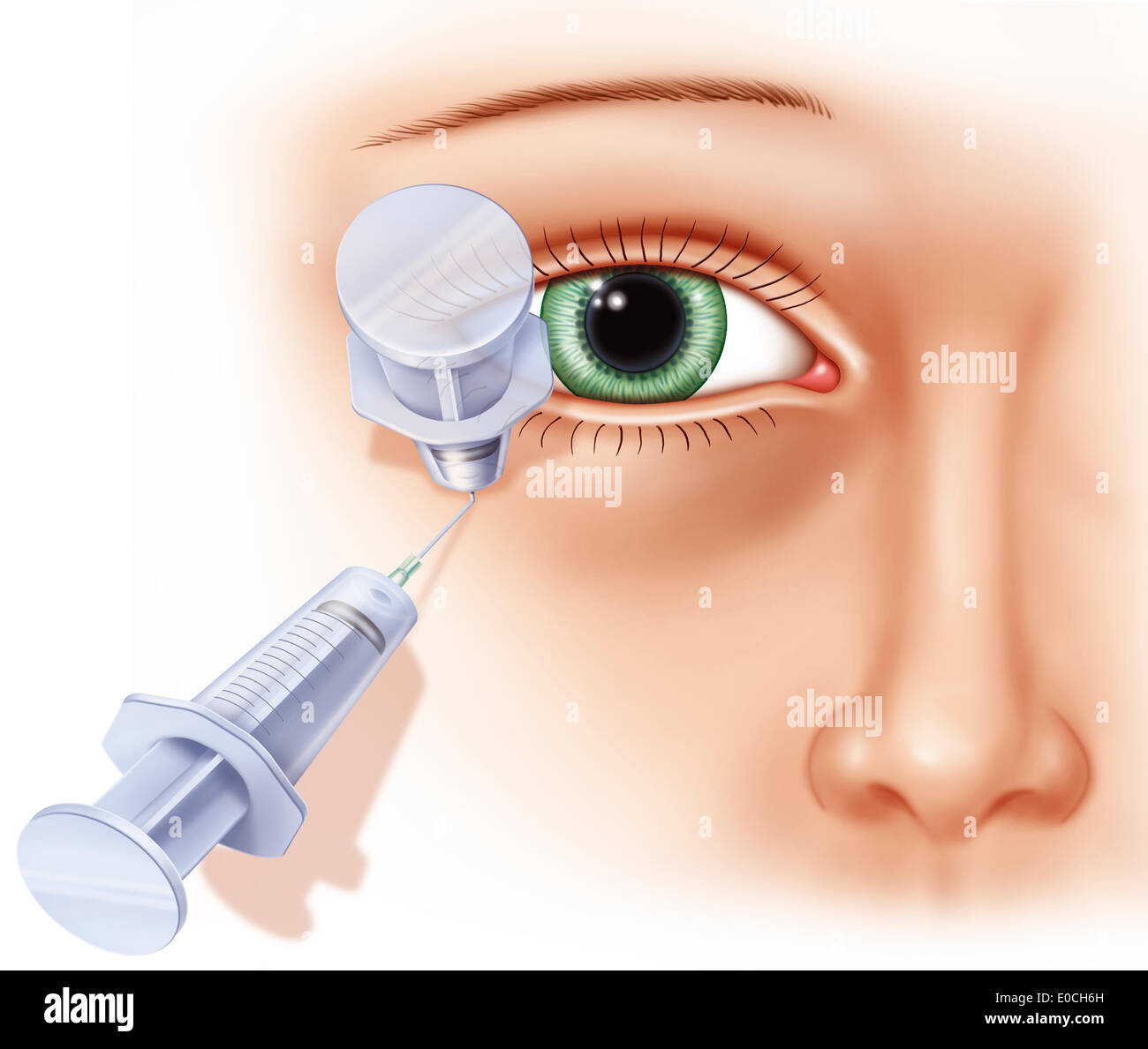 Peribulbar anaesthesia hi-res stock photography and images - Alamy