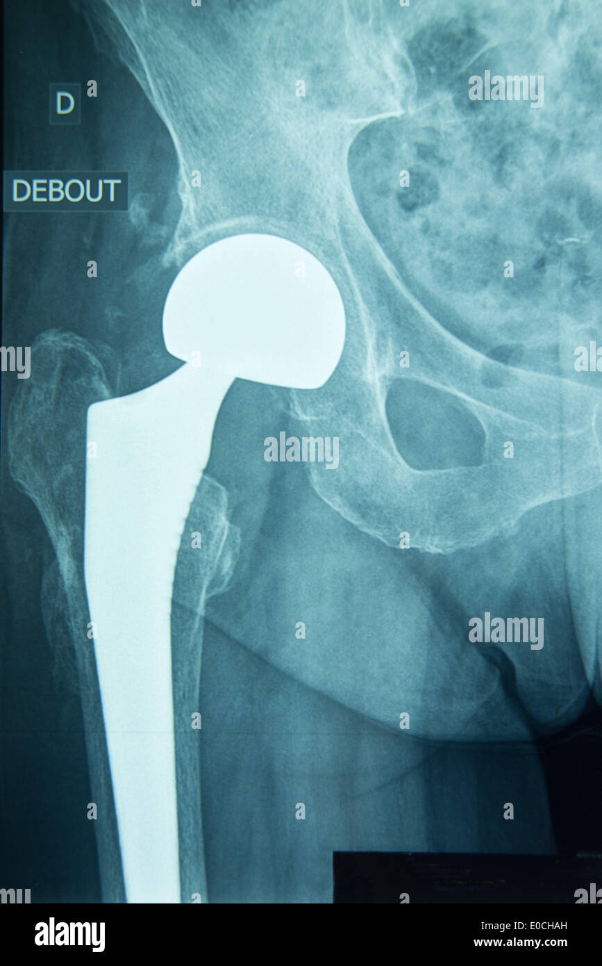 Hip prosthesis, surgery Stock Photo - Alamy