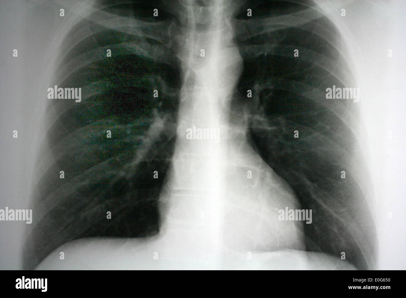 Lung X-ray examination Stock Photo - Alamy
