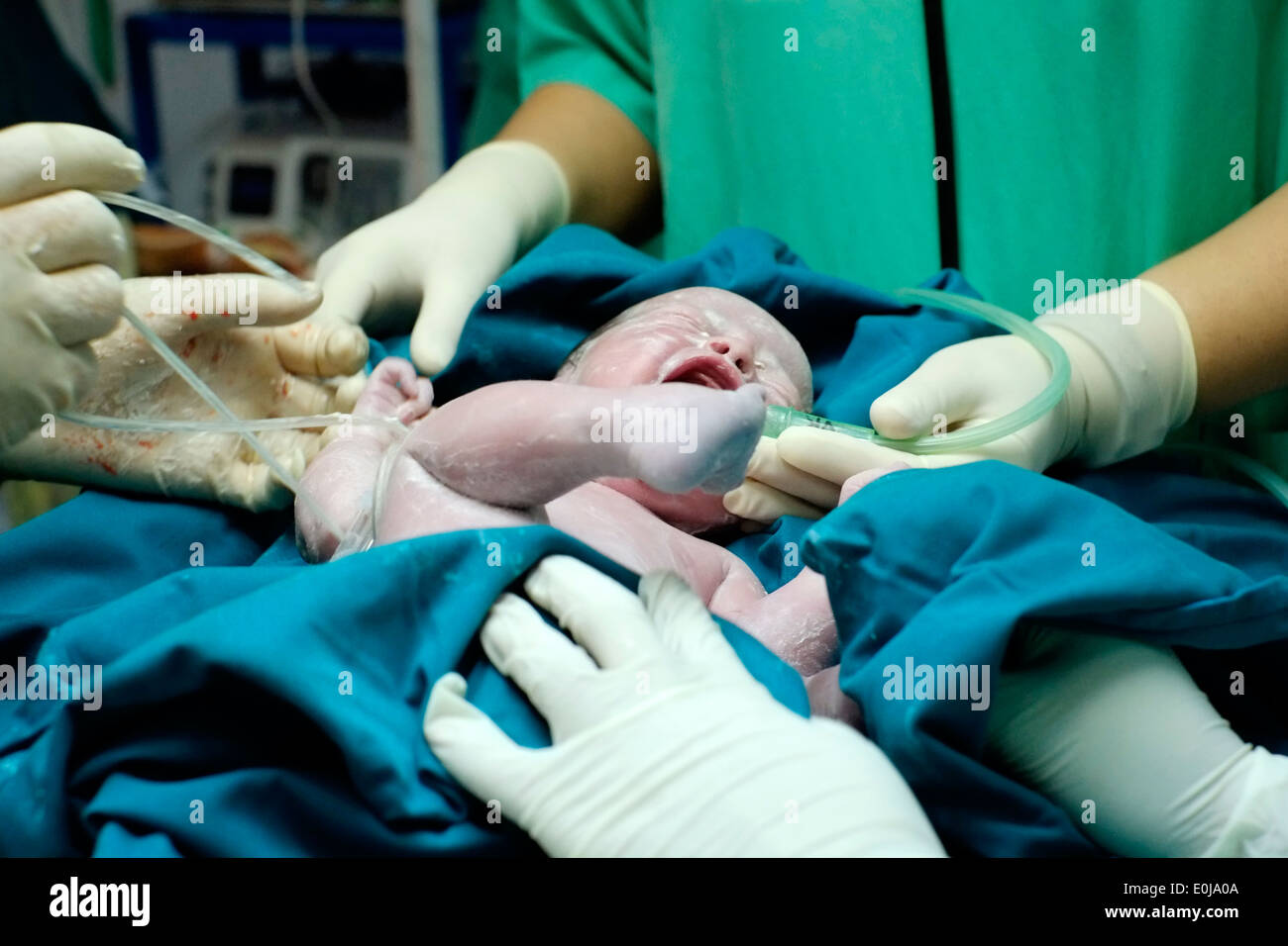 Cesarean hi-res stock photography and images - Alamy