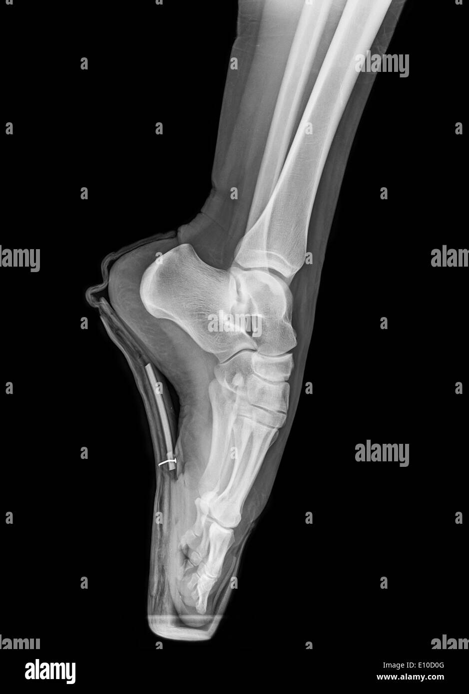 x-ray of a ballet dancer standing on pointe Stock Photo - Alamy