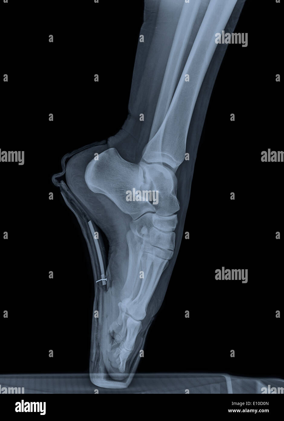 x-ray of a ballet dancer standing on pointe Stock Photo - Alamy
