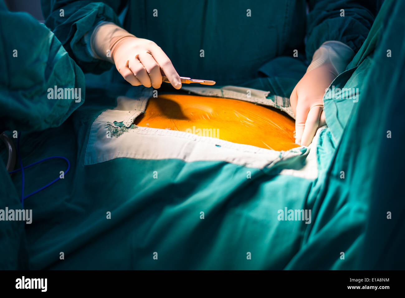 median sternotomy incision Stock Photo - Alamy